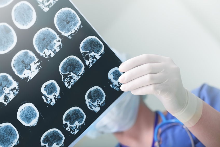 What is optic nerves and why is it so essential to our eyesight?