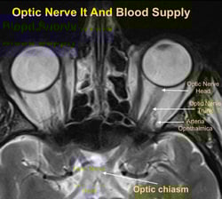 What is NAION and Is Eyesight Loss Irreversible? Research and Practice