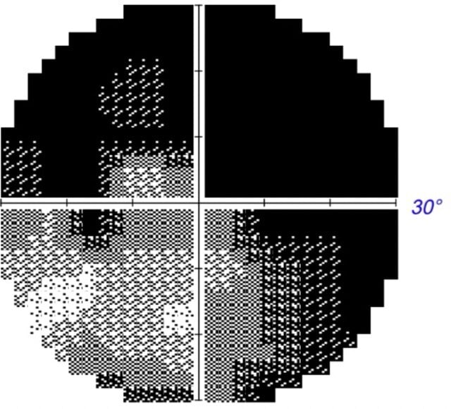 My Journey Through Glaucoma: From Losing Sight to Regaining Independence