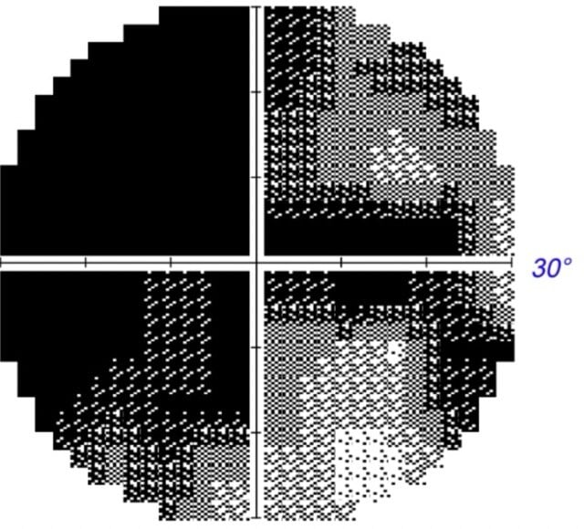 My Journey Through Glaucoma: From Losing Sight to Regaining Independence