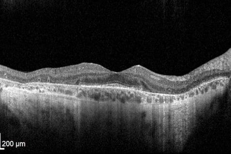 What is Retinitis Pigmentosa and it symptoms? Can it be cured or prevented?