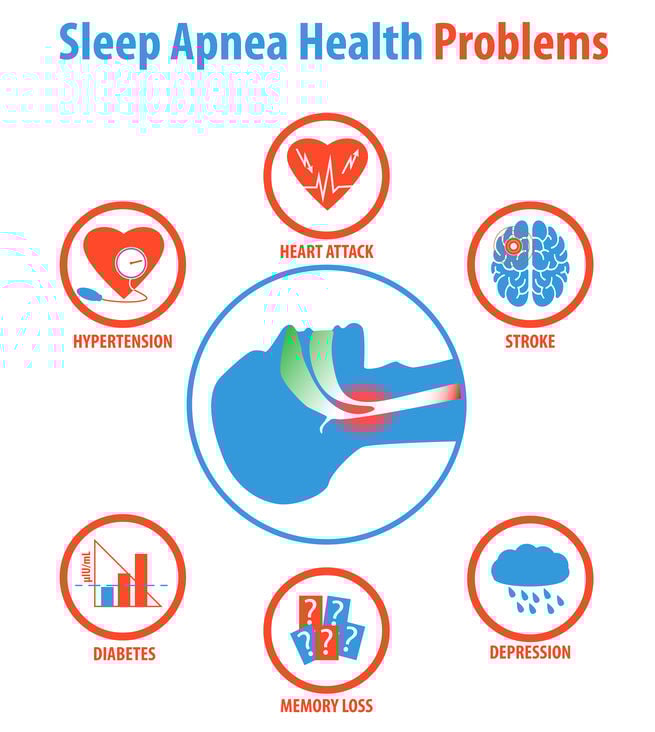 Sleep Apnea Is a Risk For Optic Nerve Damage