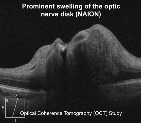 What is NAION and Is Eyesight Loss Irreversible? Research and Practice